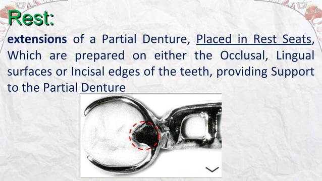 Rest and Rest Seat preparation..removable partial denture | PPT ...