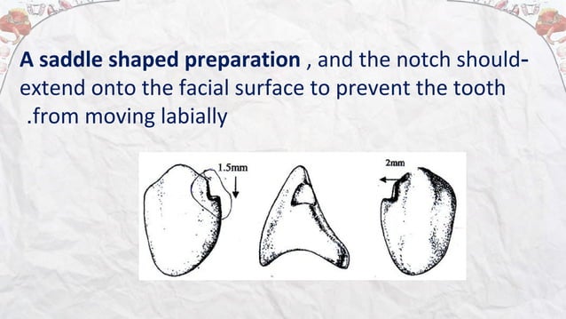 Rest and Rest Seat preparation..removable partial denture | PPT ...