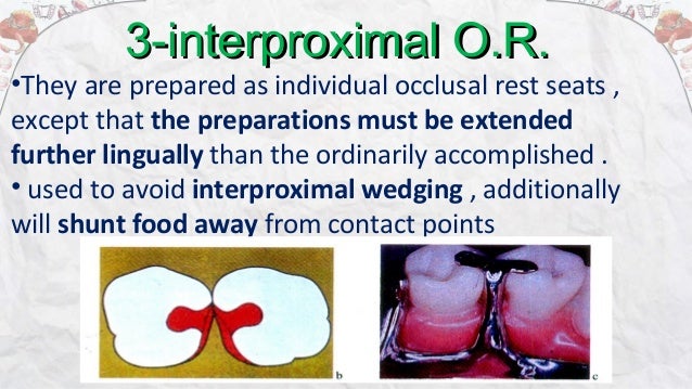 Rest and Rest Seat preparation..removable partial denture