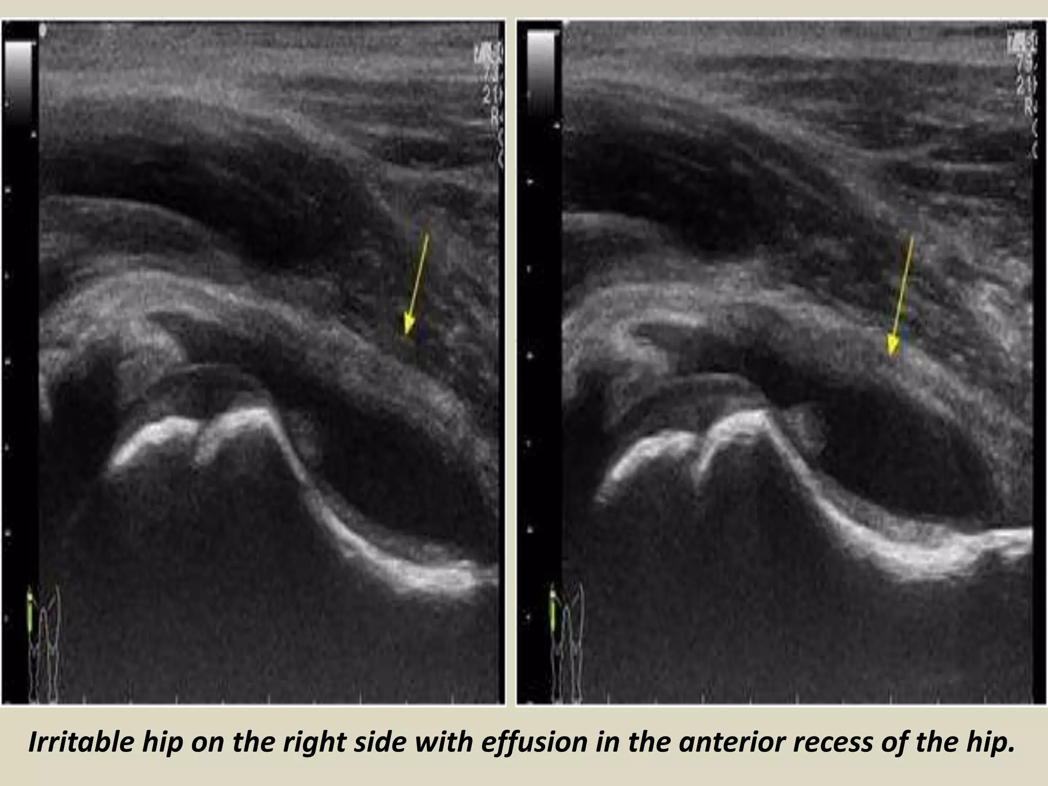 Presentation1.pptx, ultrasound examination of the hip joint | PPTX