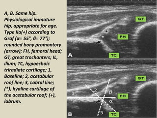 Presentation1.pptx, ultrasound examination of the hip joint | PPTX
