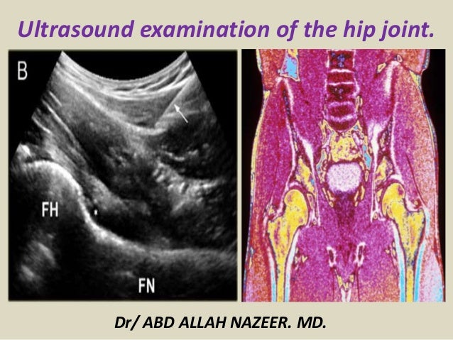 Presentation1pptx Ultrasound Examination Of The Hip Joint