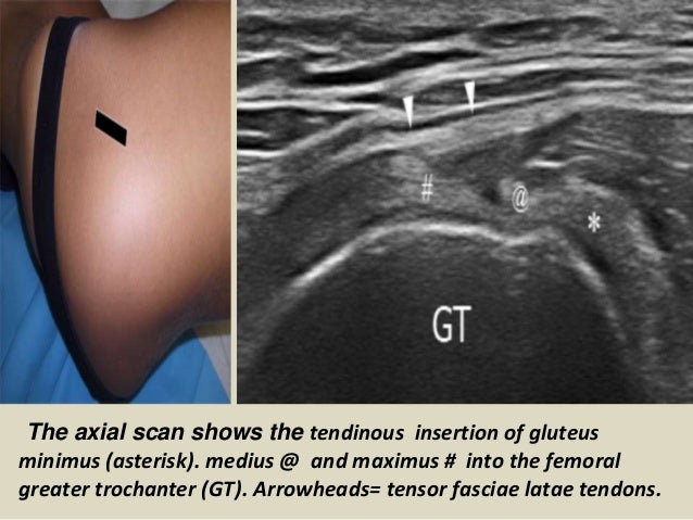 Presentation1.pptx, ultrasound examination of the hip joint