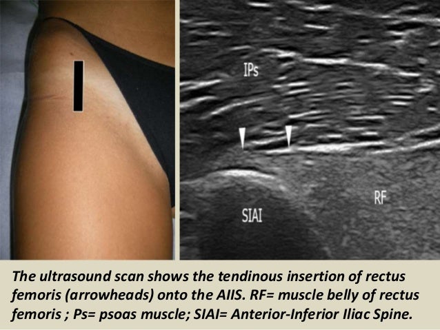 Presentation1pptx Ultrasound Examination Of The Hip Joint