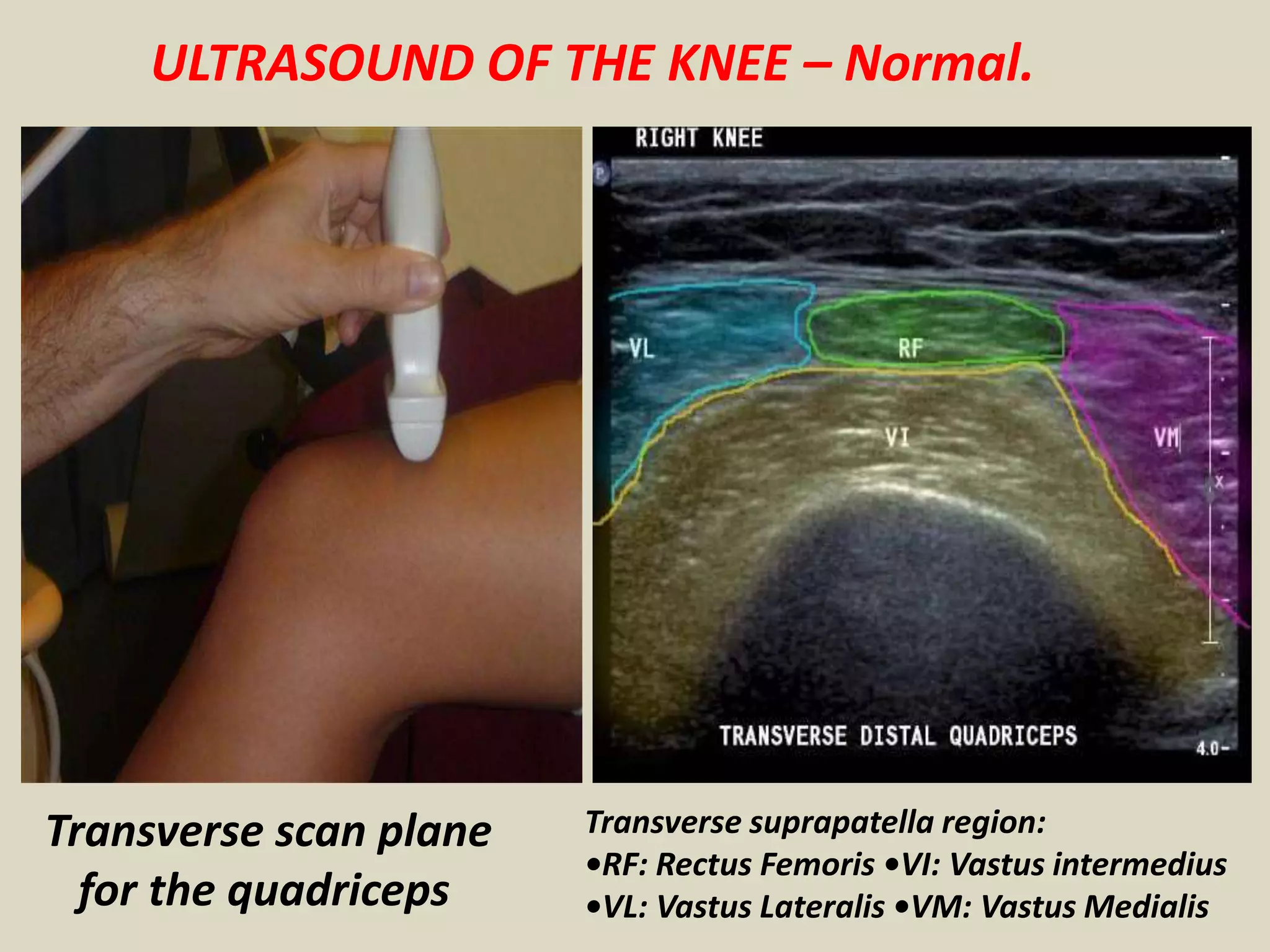 Presentation1.pptx, ultrasound examination of the knee joint. | PPTX