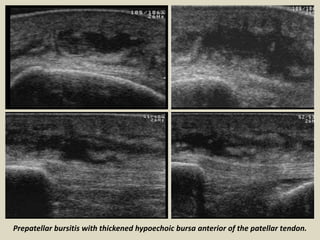 Prepatellar Bursitis Ultrasound