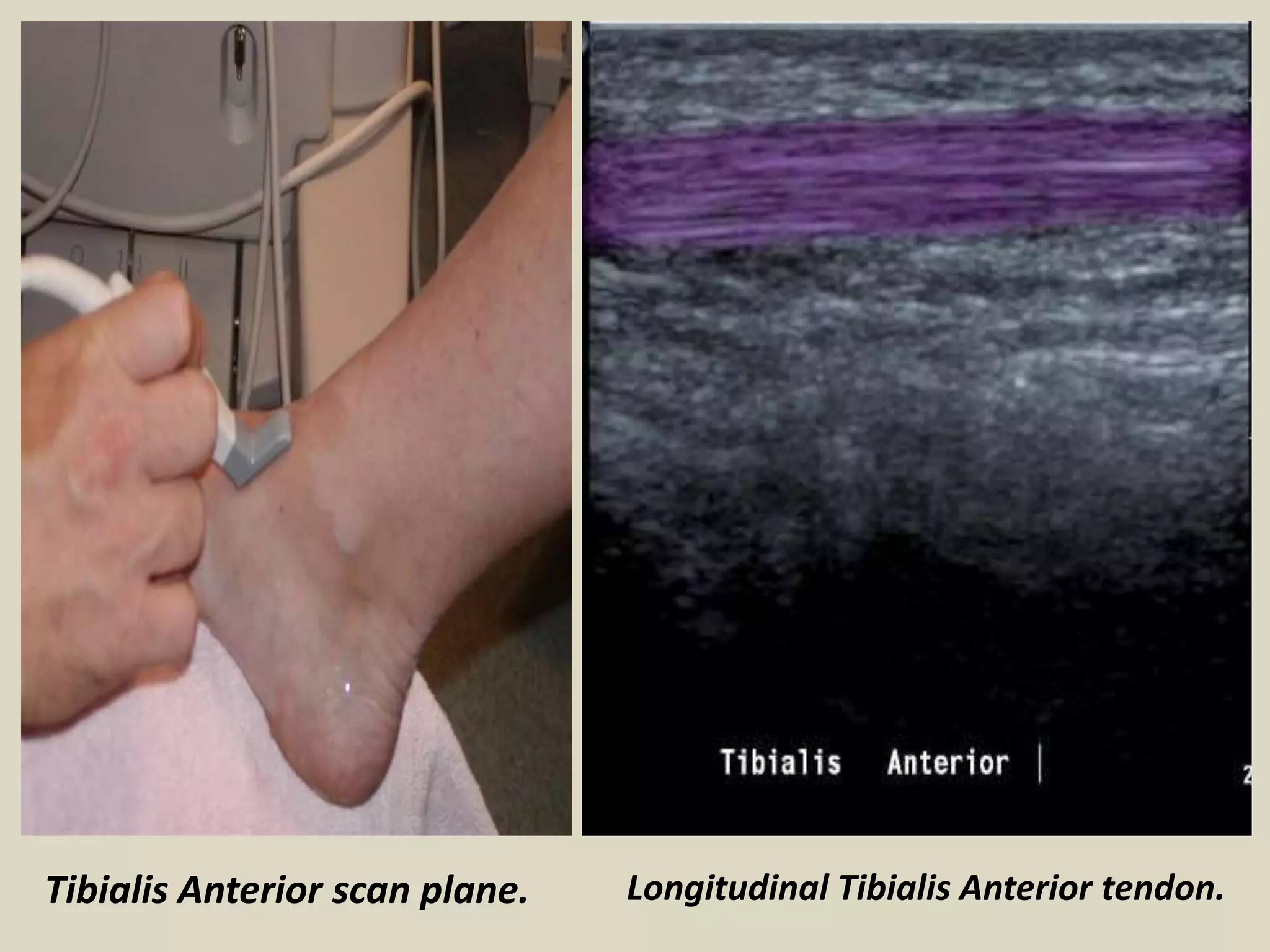 Presentation1.pptx. ultrasound examination of the ankle joint. | PPTX
