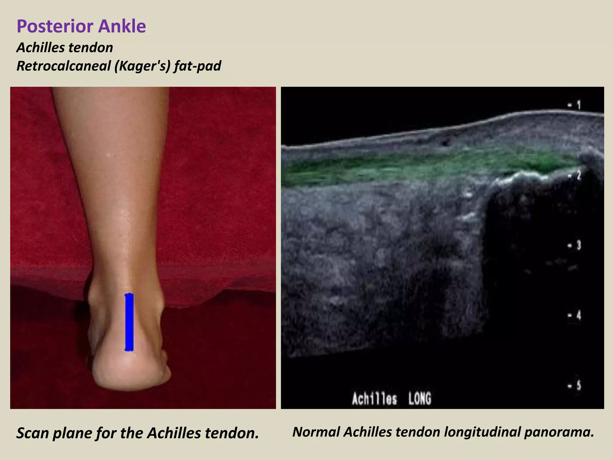 Presentation1.pptx. ultrasound examination of the ankle joint. | PPTX
