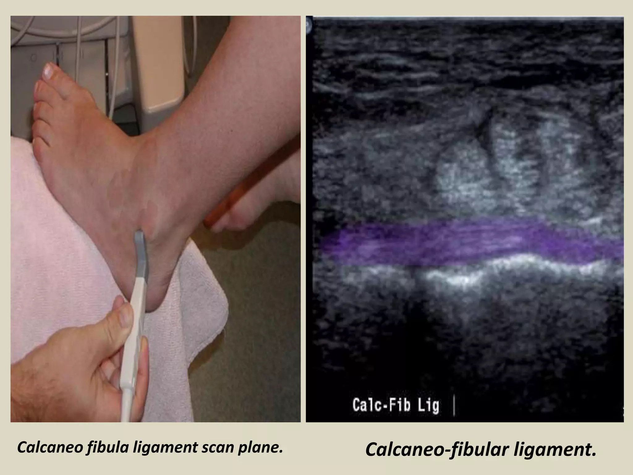 Presentation1.pptx. ultrasound examination of the ankle joint. | PPTX