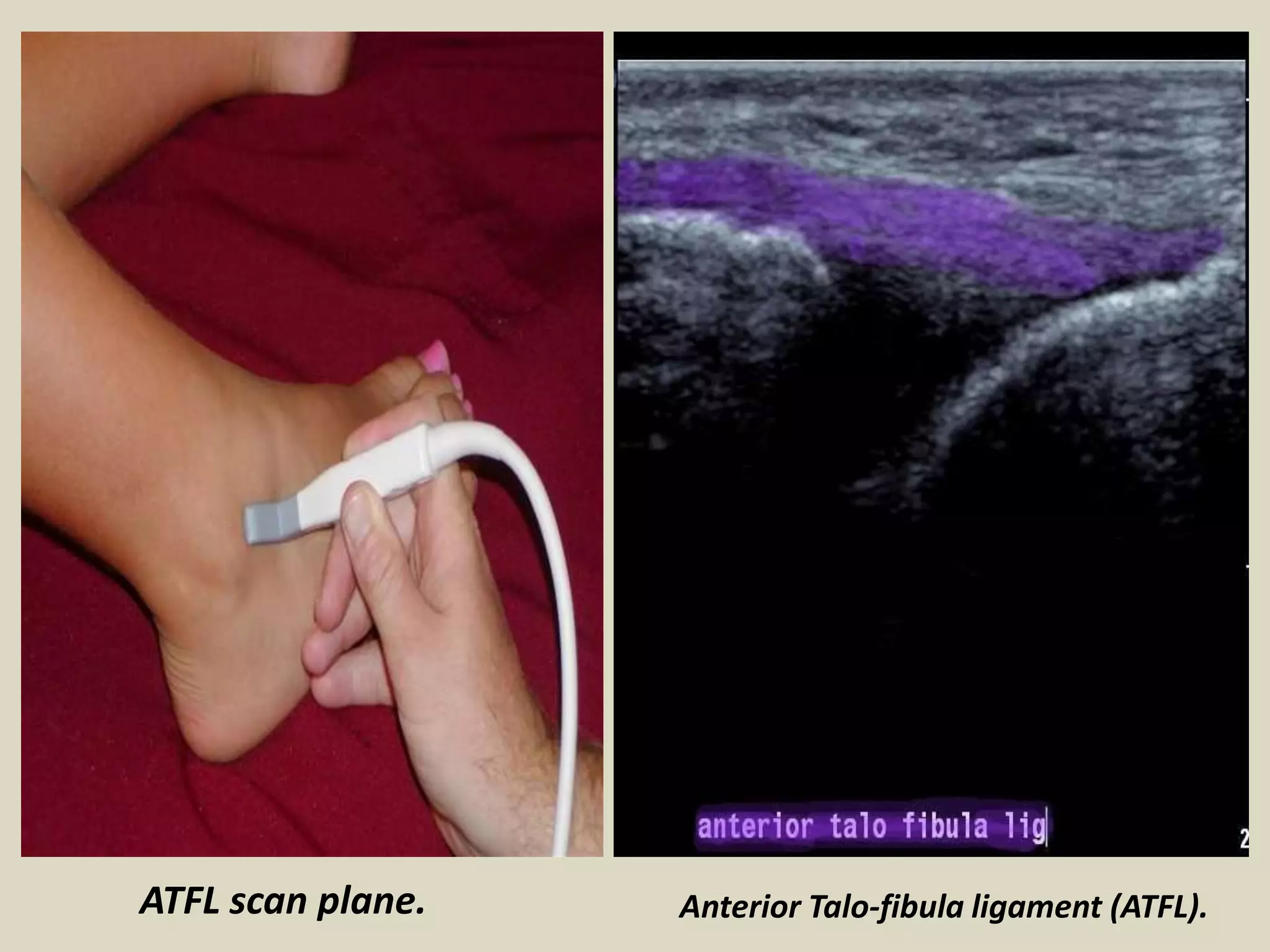 Presentation1.pptx. ultrasound examination of the ankle joint. | PPTX