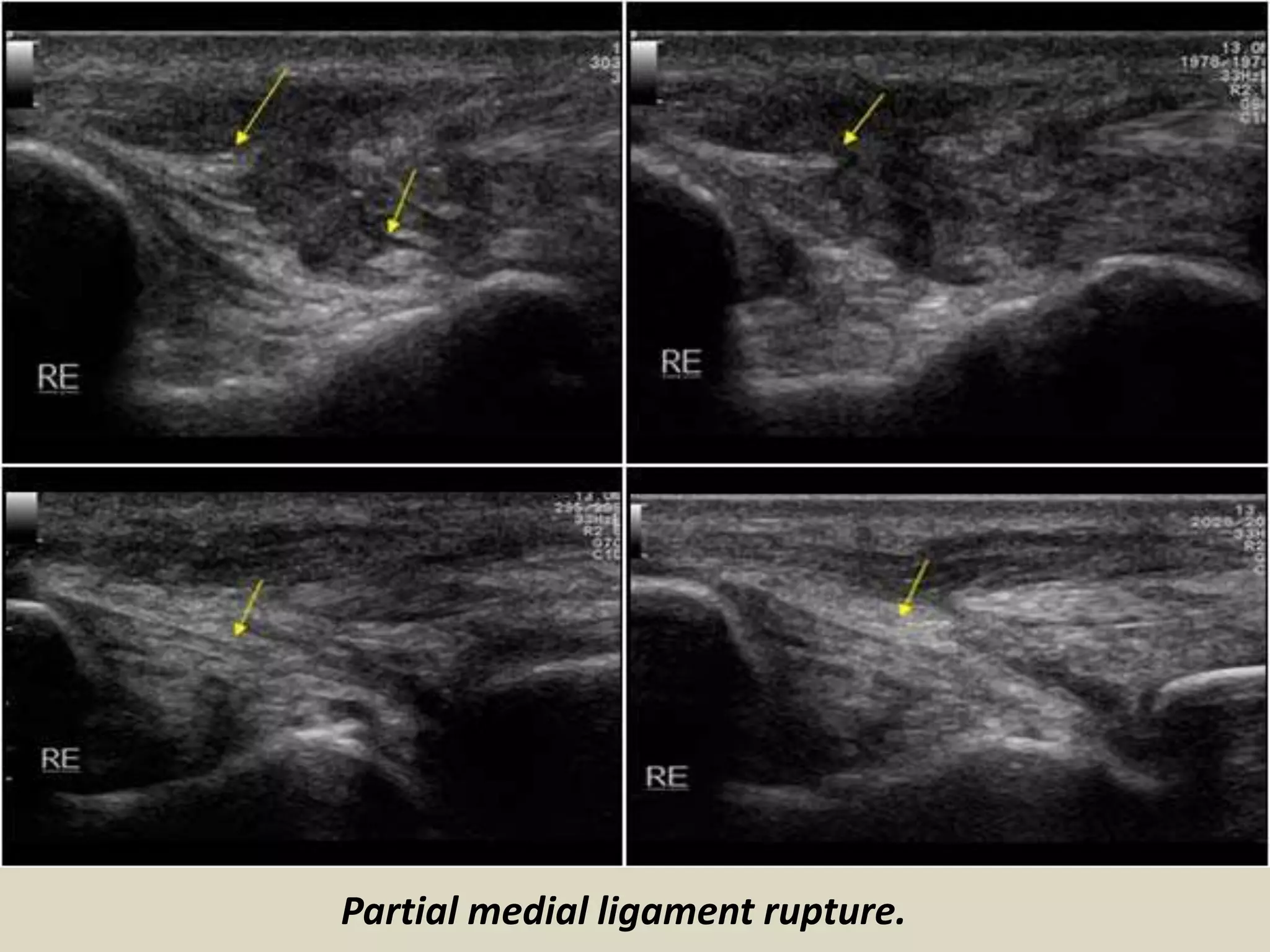 Presentation1.pptx. ultrasound examination of the ankle joint. | PPTX
