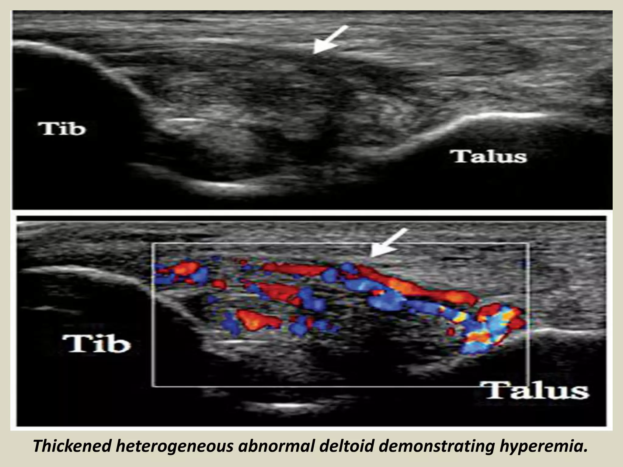 Presentation1.pptx. ultrasound examination of the ankle joint. | PPTX