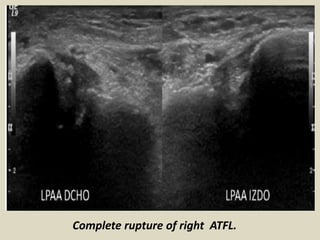 Presentation1.pptx. ultrasound examination of the ankle joint. | PPTX