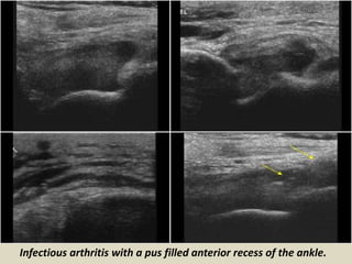 Presentation1.pptx. ultrasound examination of the ankle joint. | PPTX
