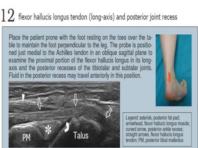 Presentation1 Pptx Ultrasound Examination Of The Ankle Joint Ppt