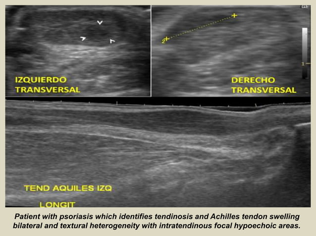Presentation1 Pptx Ultrasound Examination Of The Ankle Joint Ppt