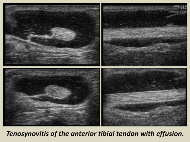 Presentation1 Pptx Ultrasound Examination Of The Ankle Joint Ppt