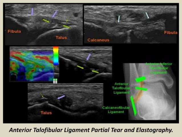 Presentation1 Pptx Ultrasound Examination Of The Ankle Joint Ppt