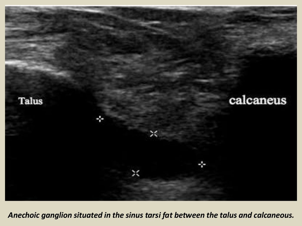 Presentation1 Pptx Ultrasound Examination Of The Ankle Joint