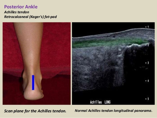 Presentation1.pptx. ultrasound examination of the ankle joint.
