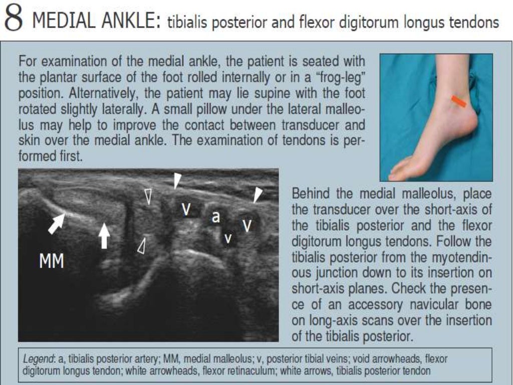 Presentation1 Pptx Ultrasound Examination Of The Ankle Joint
