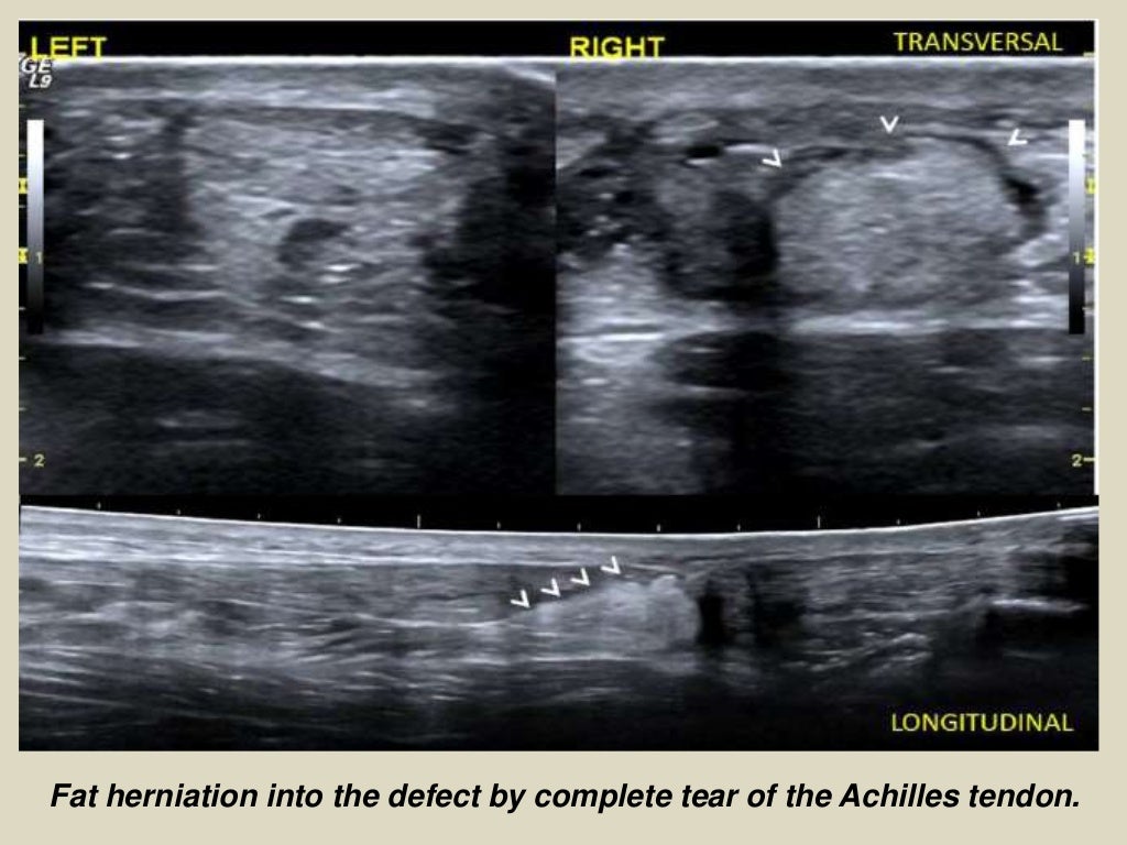 Presentation1 Pptx Ultrasound Examination Of The Ankle Joint