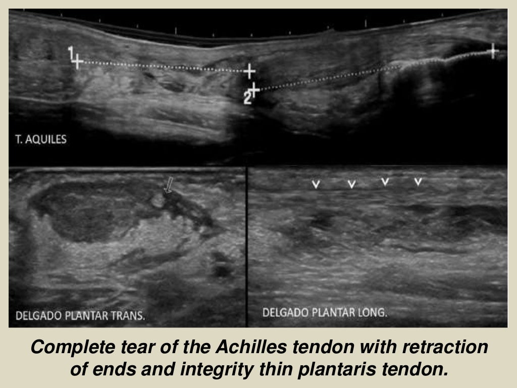 Presentation1 Pptx Ultrasound Examination Of The Ankle Joint