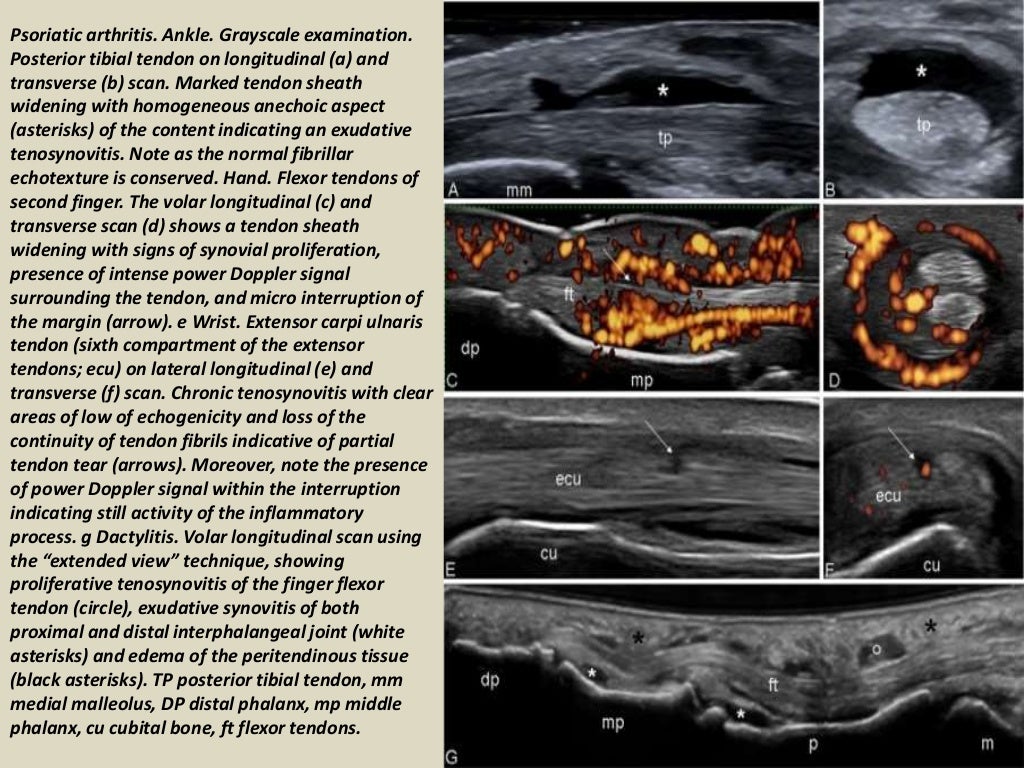 Presentation1 Pptx Ultrasound Examination Of The Ankle Joint