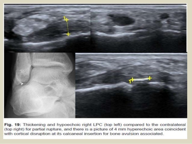 Presentation1.pptx. ultrasound examination of the ankle joint.