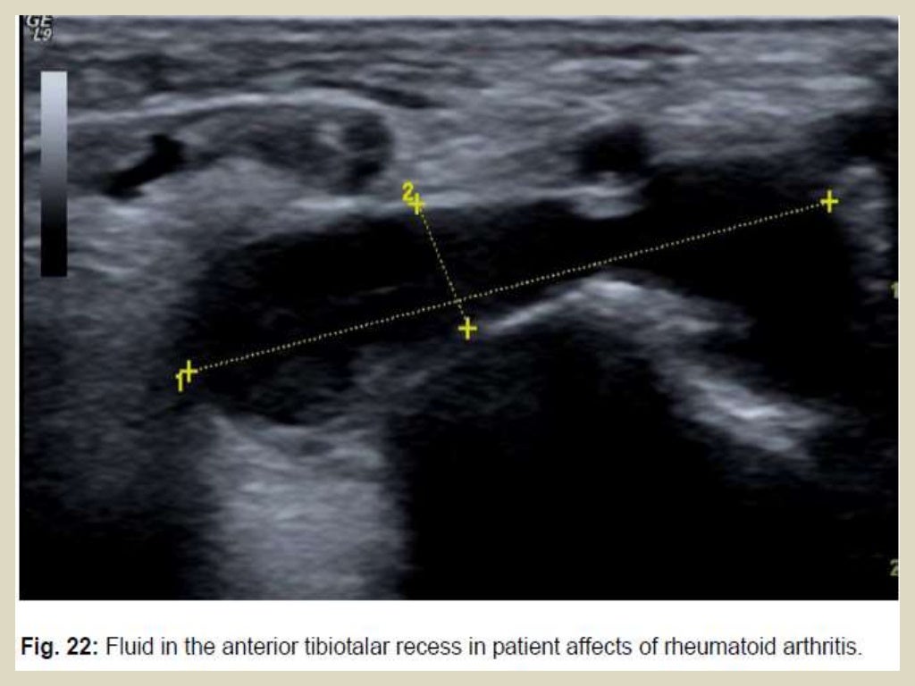 Presentation1 Pptx Ultrasound Examination Of The Ankle Joint