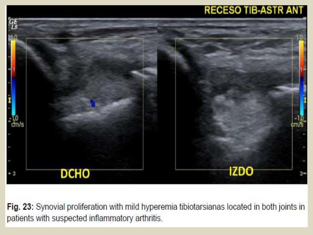 Presentation1 Pptx Ultrasound Examination Of The Ankle Joint