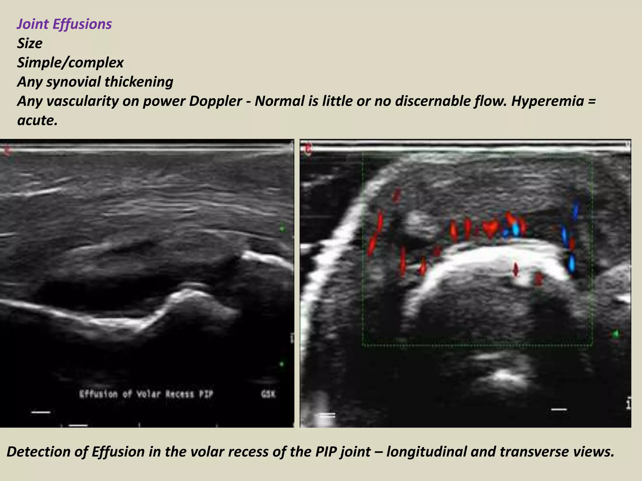 Presentation1.pptx, ultrasound of the hand and fingers. | PPTX