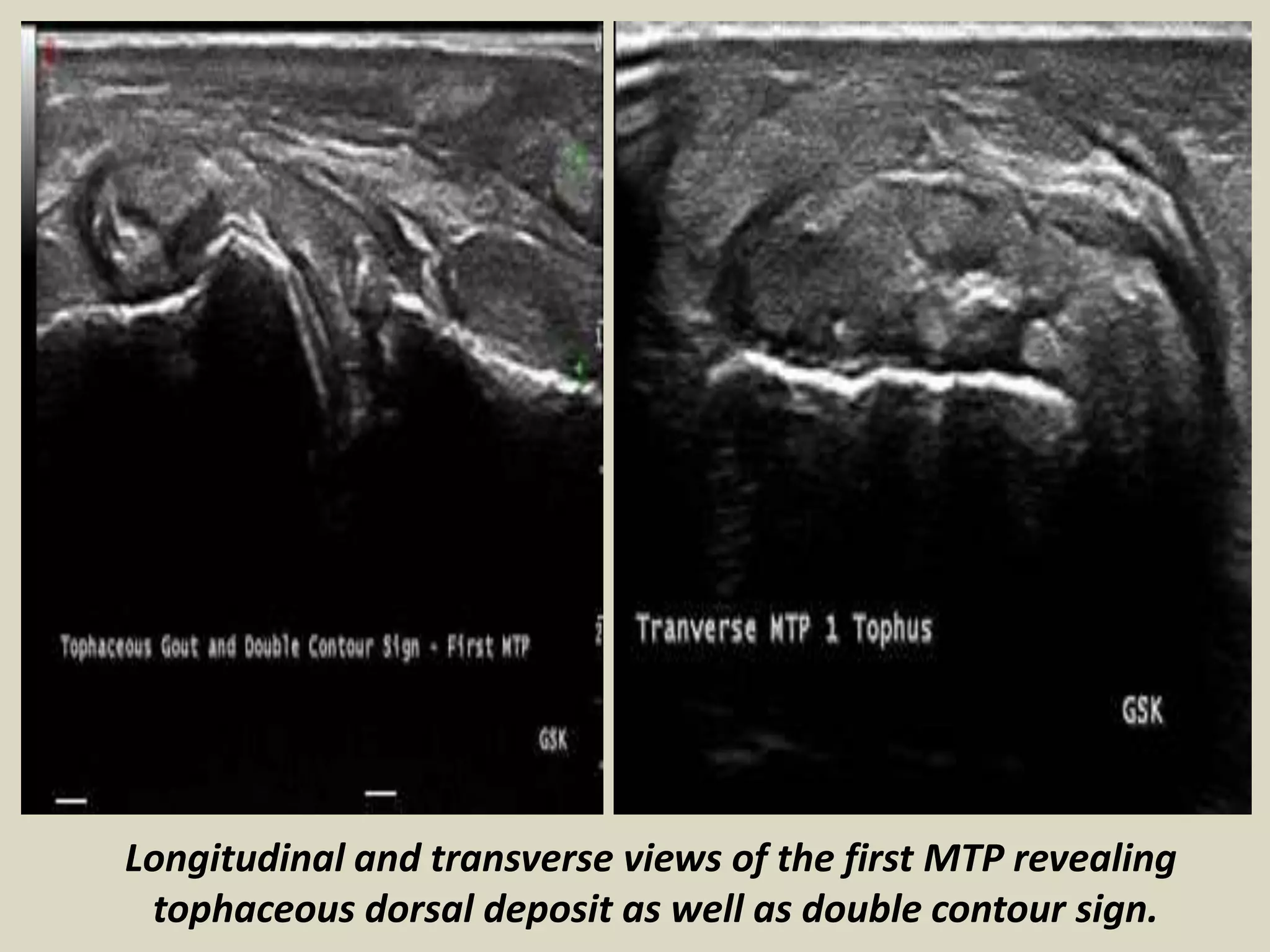 Presentation1.pptx, ultrasound of the hand and fingers. | PPTX