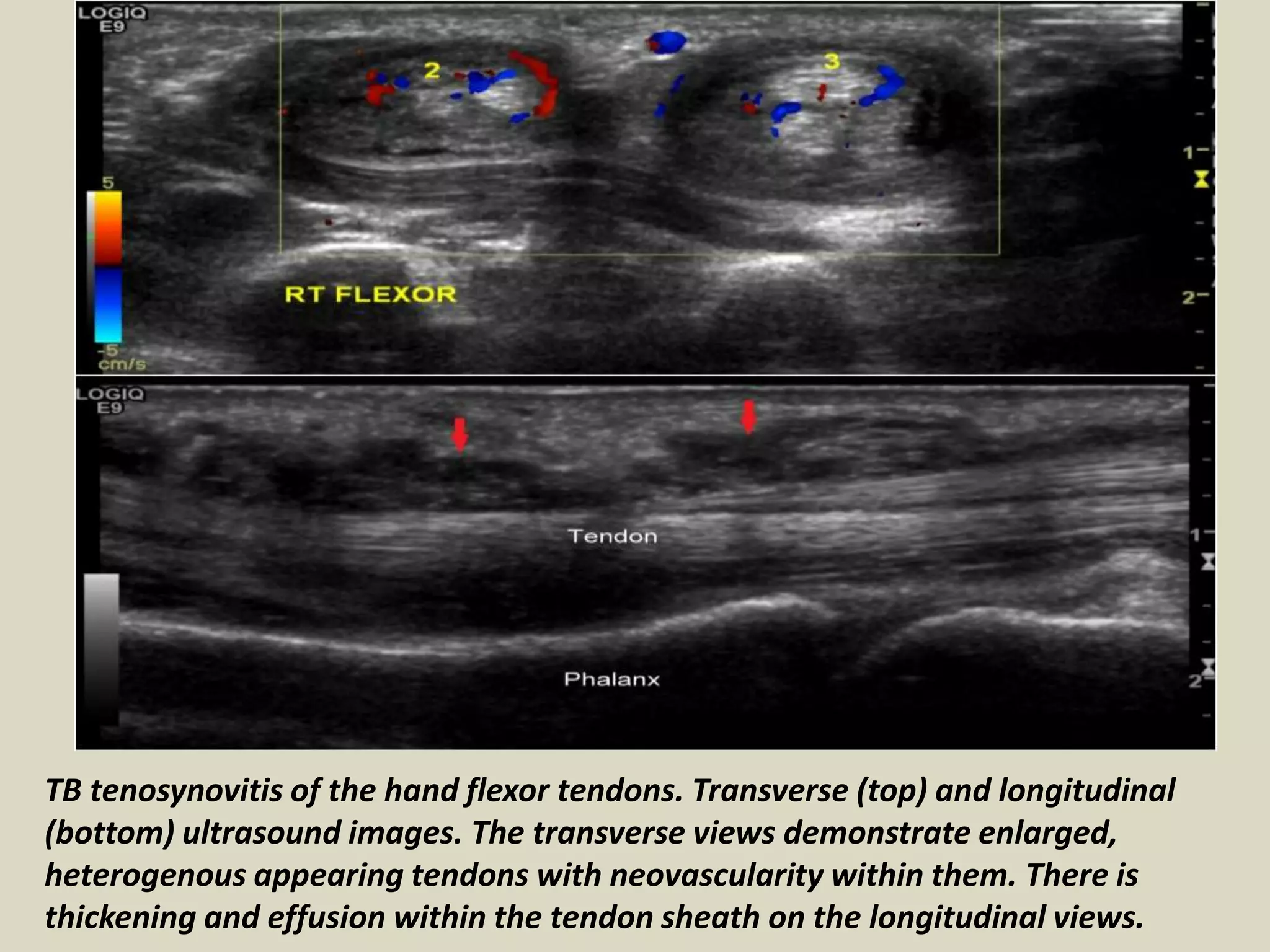 Presentation1.pptx, ultrasound of the hand and fingers. | PPTX