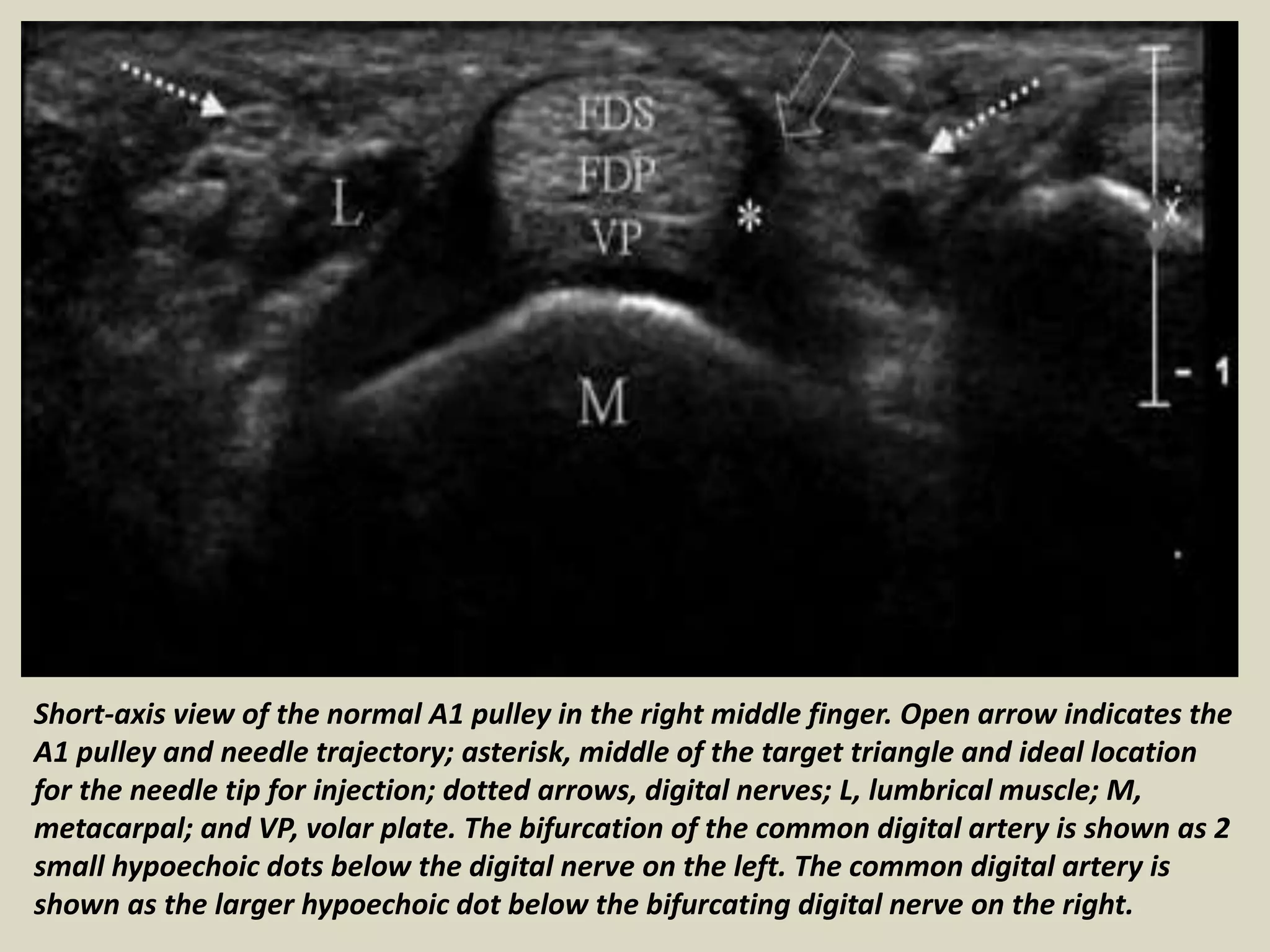 Presentation1.pptx, ultrasound of the hand and fingers. | PPTX