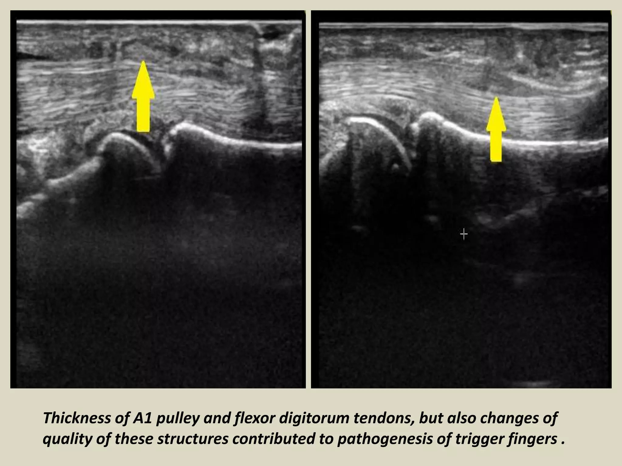 Presentation1.pptx, ultrasound of the hand and fingers. | PPTX