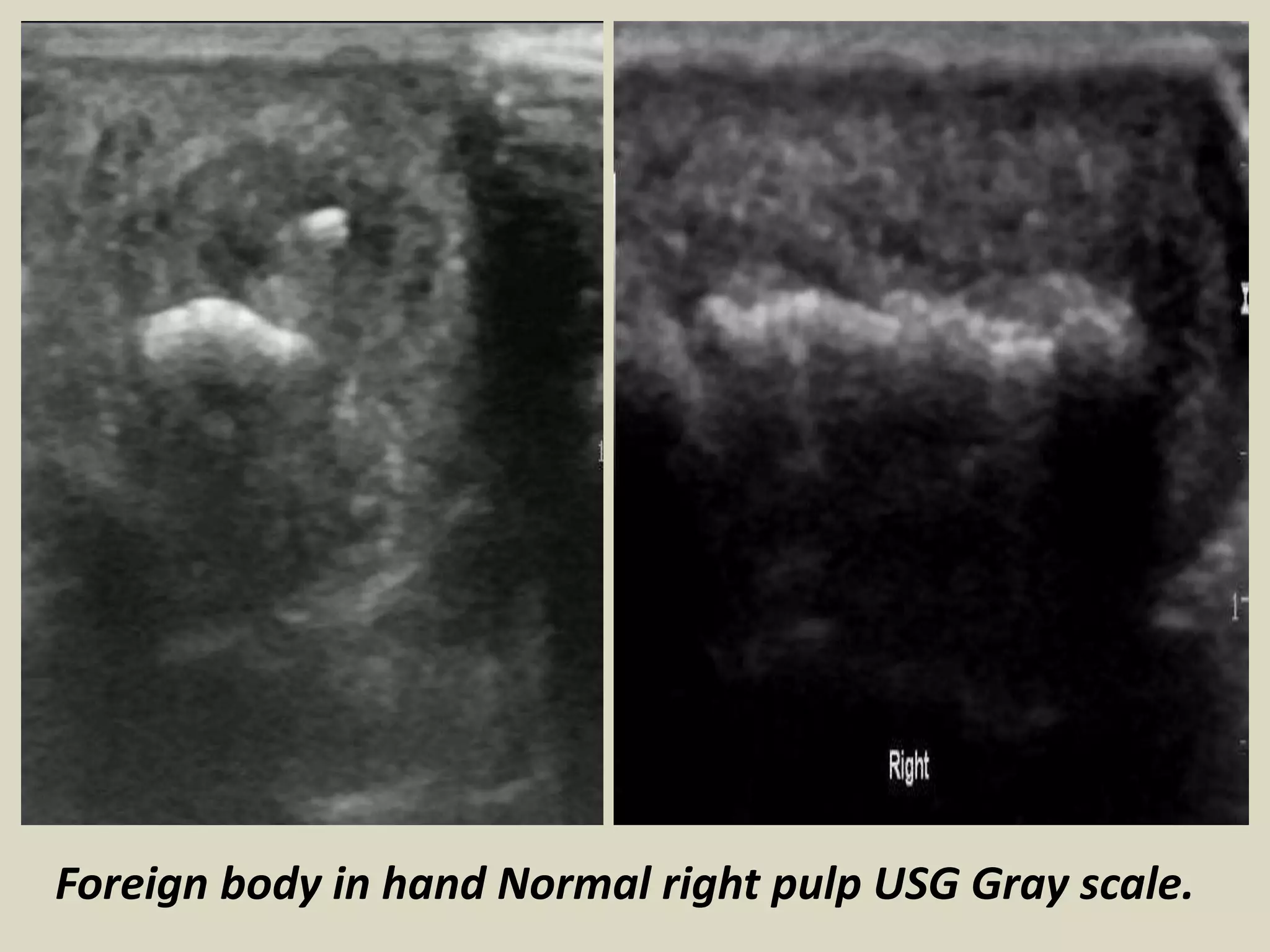 Presentation1.pptx, ultrasound of the hand and fingers. | PPTX