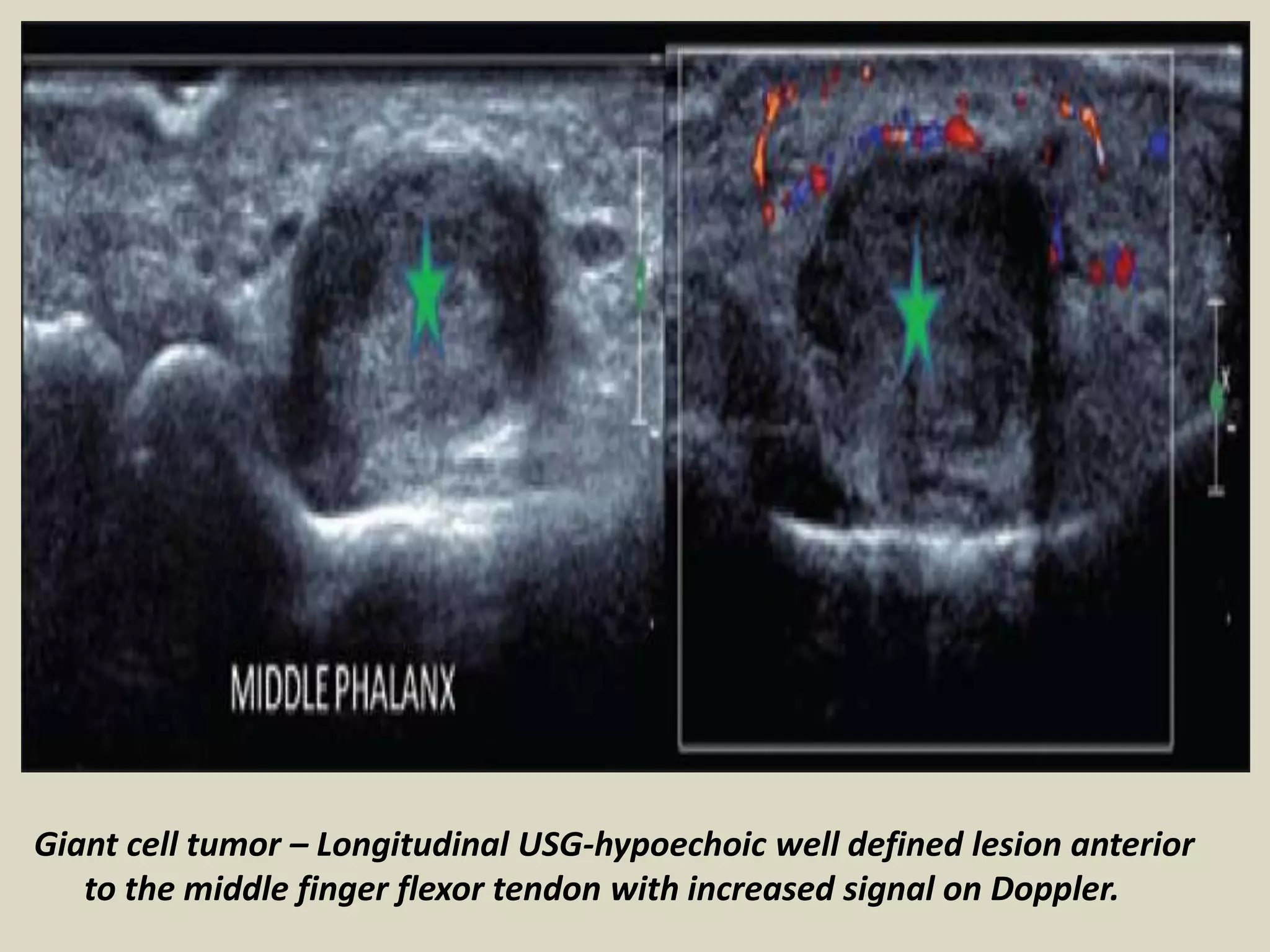 Presentation1.pptx, ultrasound of the hand and fingers. | PPTX