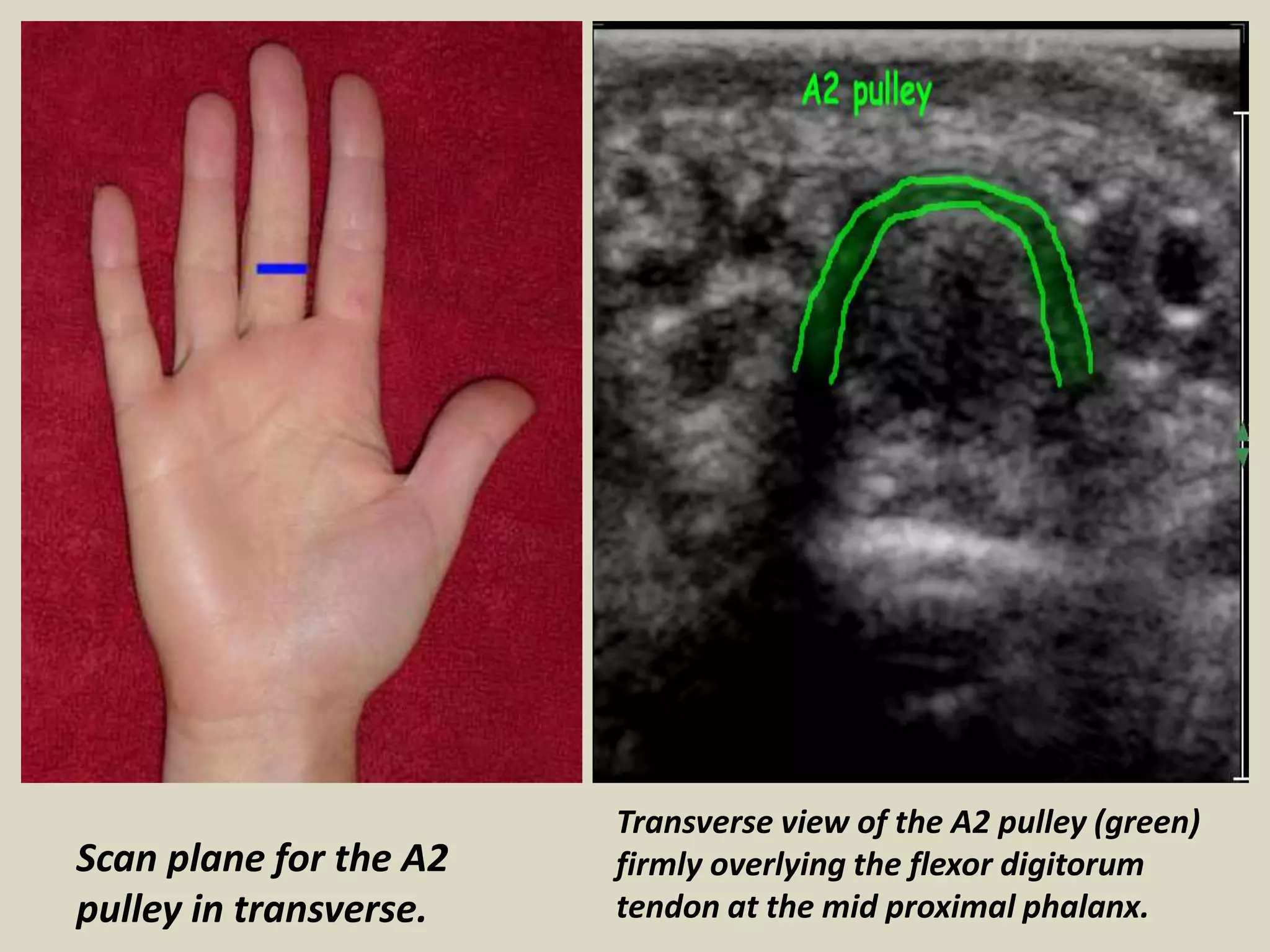 Presentation1.pptx, ultrasound of the hand and fingers. | PPTX