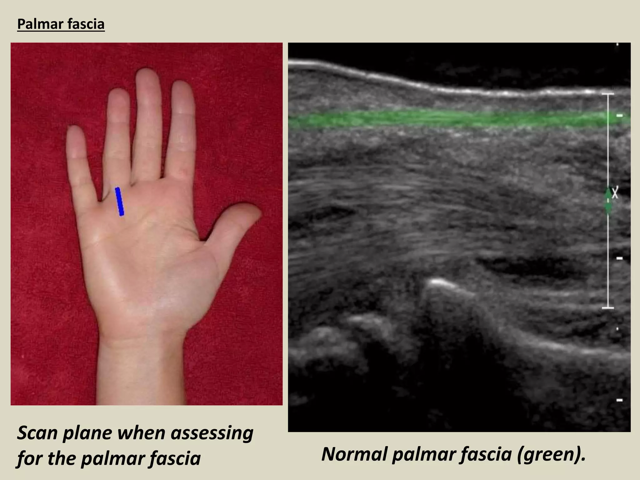 Presentation1.pptx, ultrasound of the hand and fingers. | PPTX