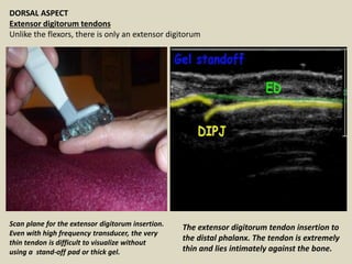 Presentation1.pptx, ultrasound of the hand and fingers. | PPTX