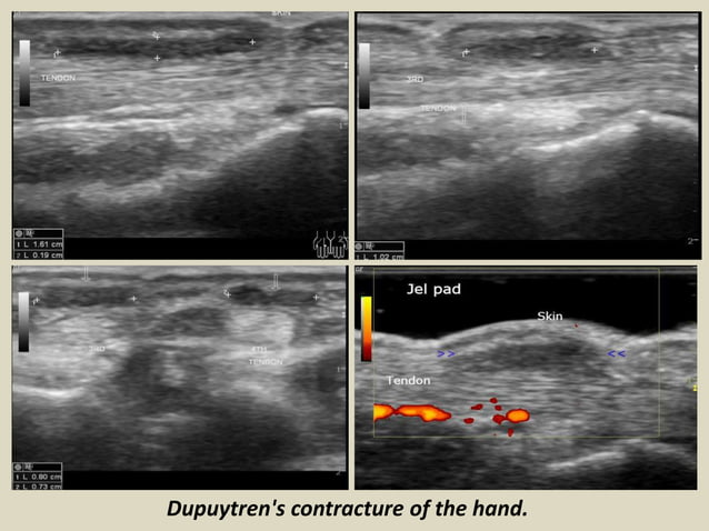 Presentation1.pptx, ultrasound of the hand and fingers. | PPTX