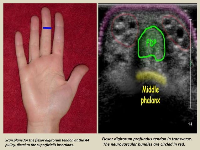 Presentation1.pptx, ultrasound of the hand and fingers. | PPT
