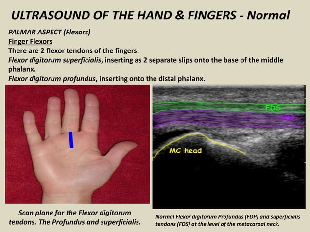 Presentation1.pptx, ultrasound of the hand and fingers.