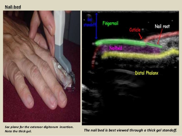 Presentation1.pptx, ultrasound of the hand and fingers.
