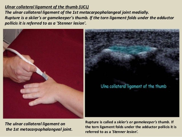 Presentation1.pptx, ultrasound of the hand and fingers.