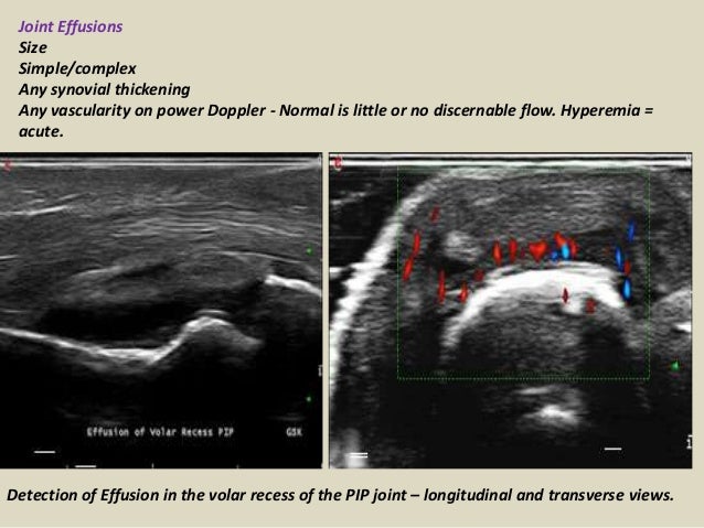 Presentation1.pptx, ultrasound of the hand and fingers.