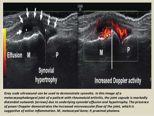 Presentation1.pptx, ultrasound of the hand and fingers.