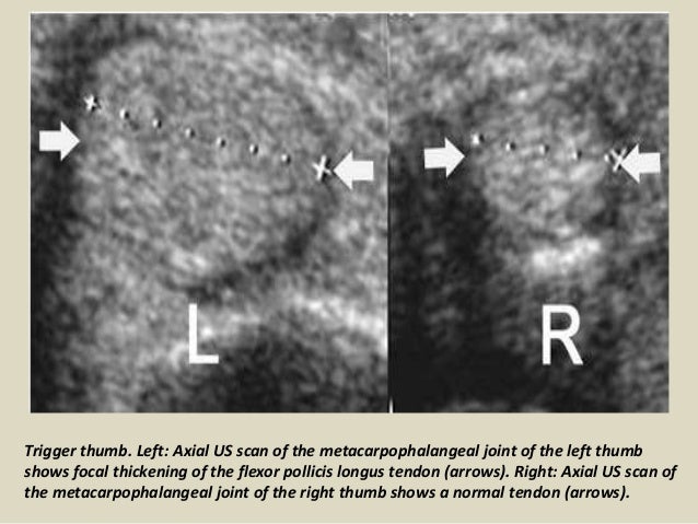 Presentation1.pptx, ultrasound of the hand and fingers.