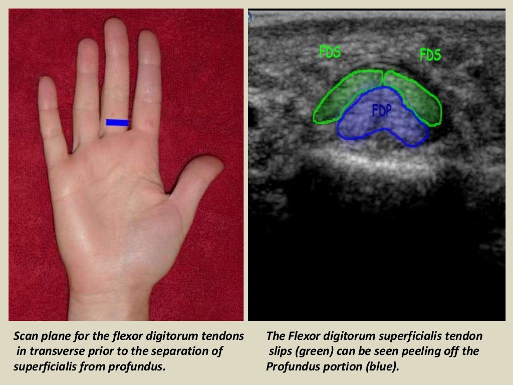 Presentation1.pptx, ultrasound of the hand and fingers.